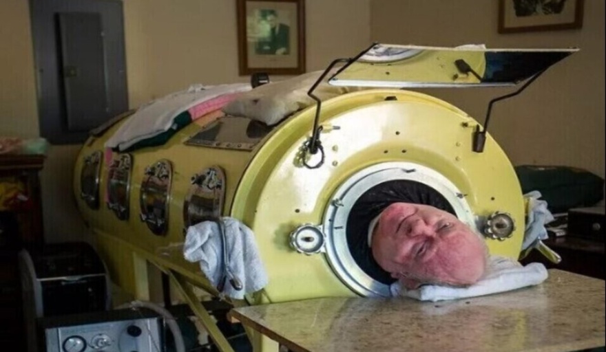 Murió Paul Alexander El Hombre Que Vivió Más De 70 Años En Un Pulmón